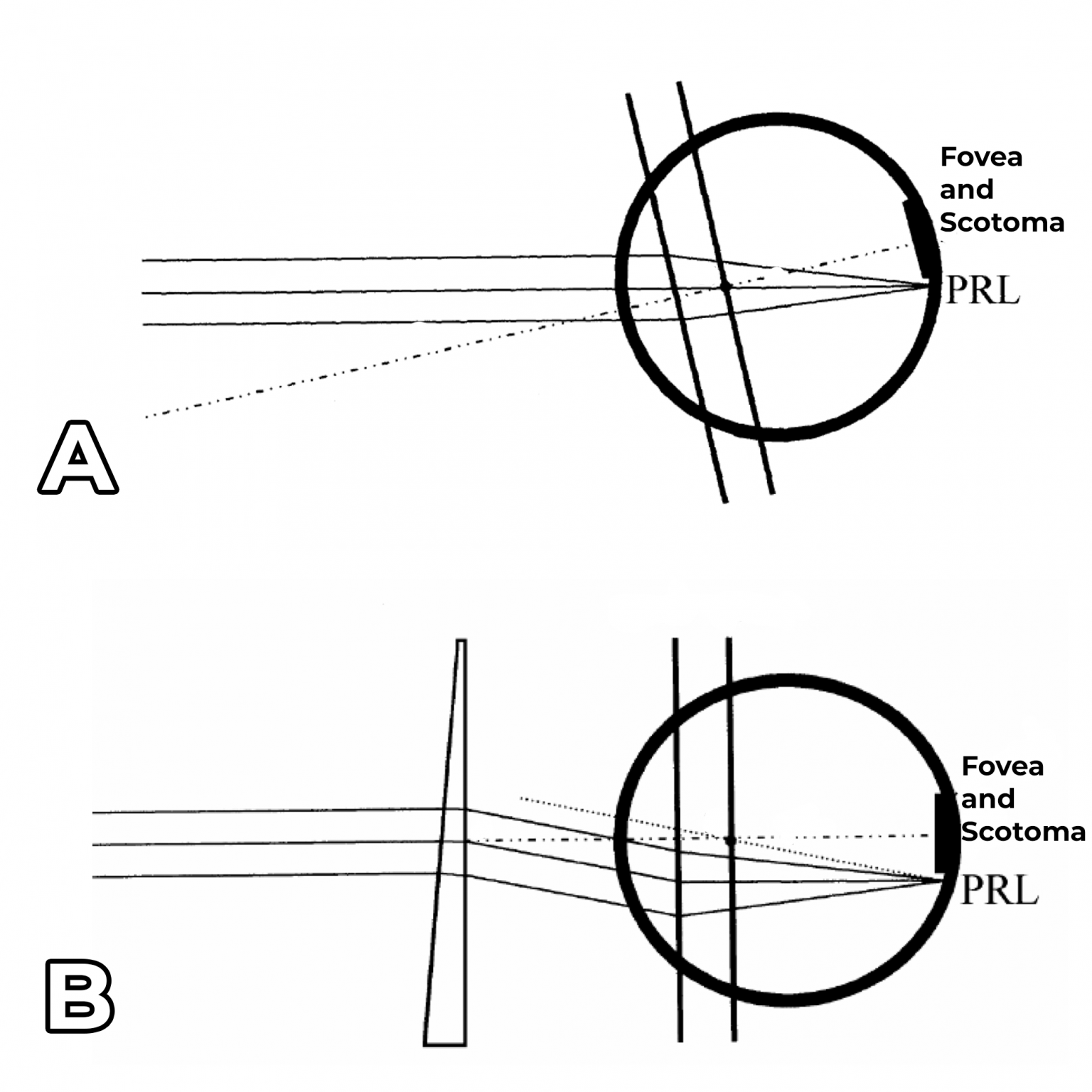 How can visually impaired people benefit from prismatic lenses? - MAFO