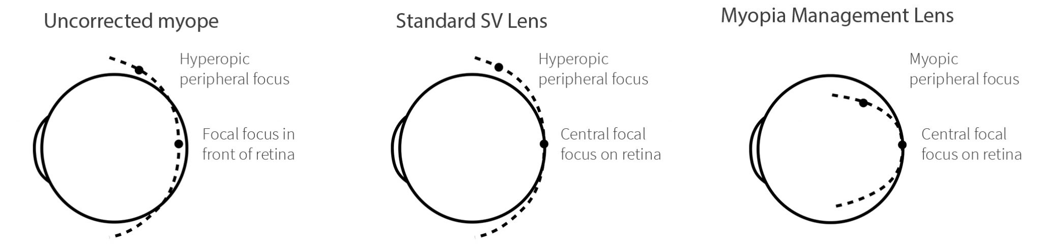 Revolutionizing myopia management - MAFO